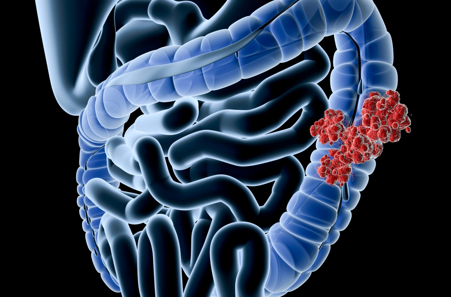 Right Hemicolectomy | Colorectal Surgeon Campbelltown